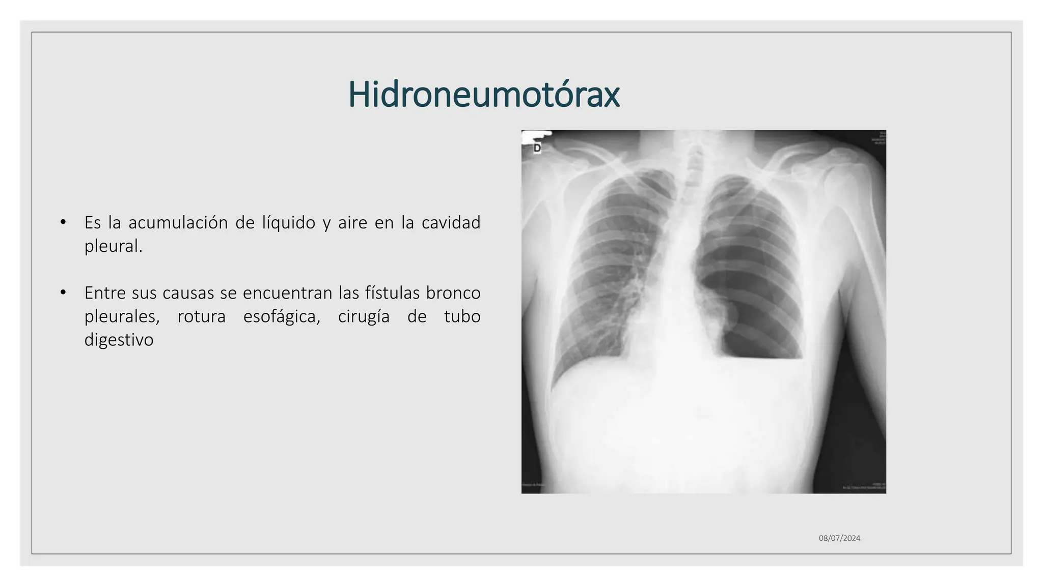 Radiografía de Tórax patológico y normal.pptx