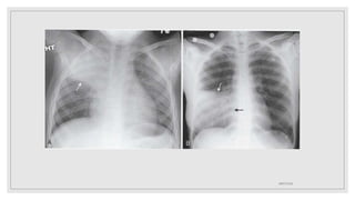 Radiografía de Tórax patológico y normal.pptx