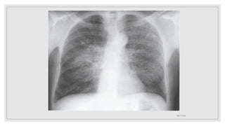 Radiografía de Tórax patológico y normal.pptx