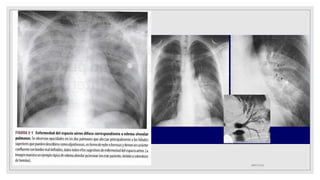 Radiografía de Tórax patológico y normal.pptx