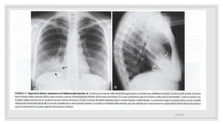 Radiografía de Tórax patológico y normal.pptx