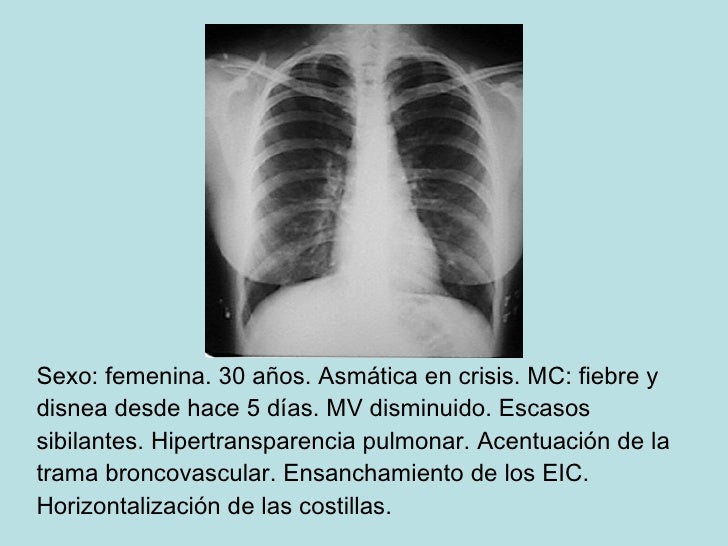 RadiografíAs De Asma