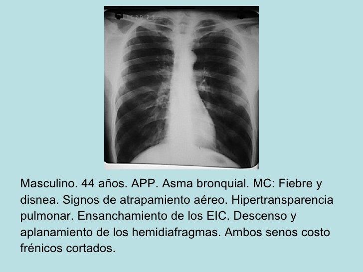 RadiografíAs De Asma