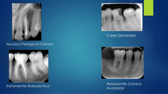 Radiografías dentales (patologías)