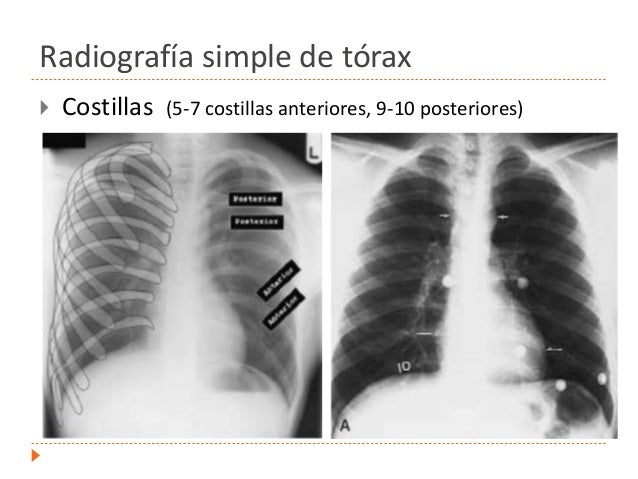 Radiografía simple y tomografía de tórax