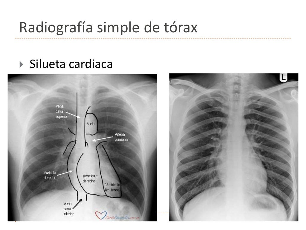 Radiografía simple y tomografía de tórax