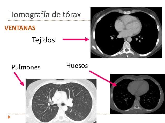 Radiografía simple y tomografía de tórax
