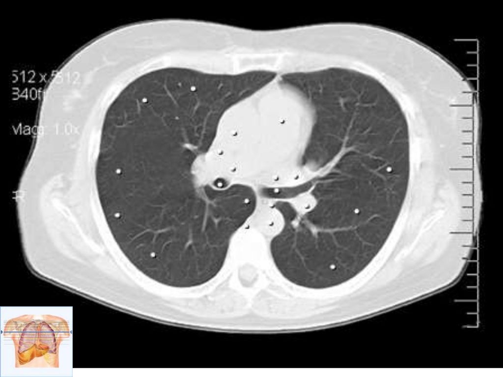 Radiografía simple y tomografía de tórax
