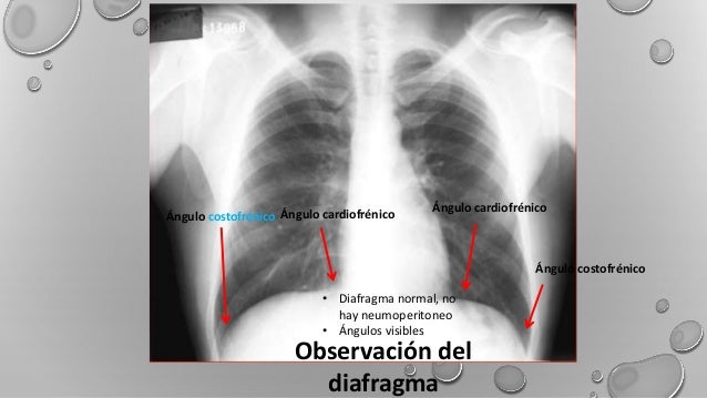 Radiografia ap y lateral del torax 2018
