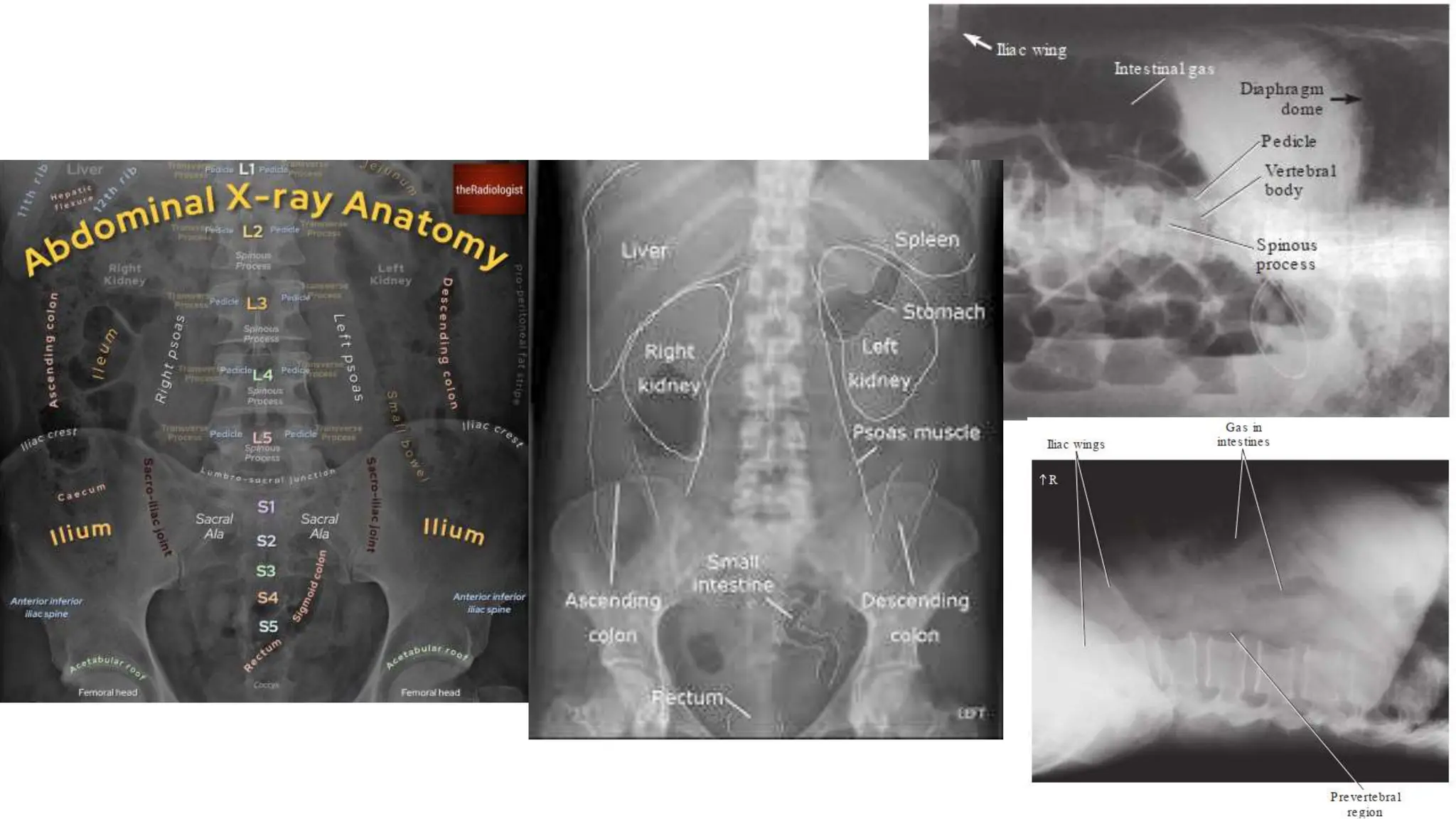 RADIOGRAFI_ABDOMEN_radiologi_abdomen_.pptx