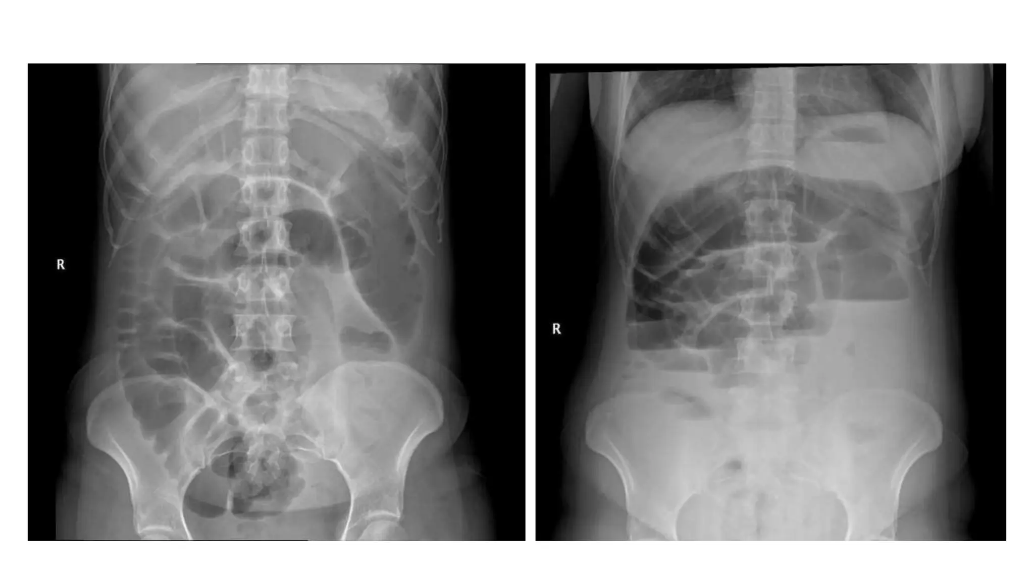 RADIOGRAFI_ABDOMEN_radiologi_abdomen_.pptx