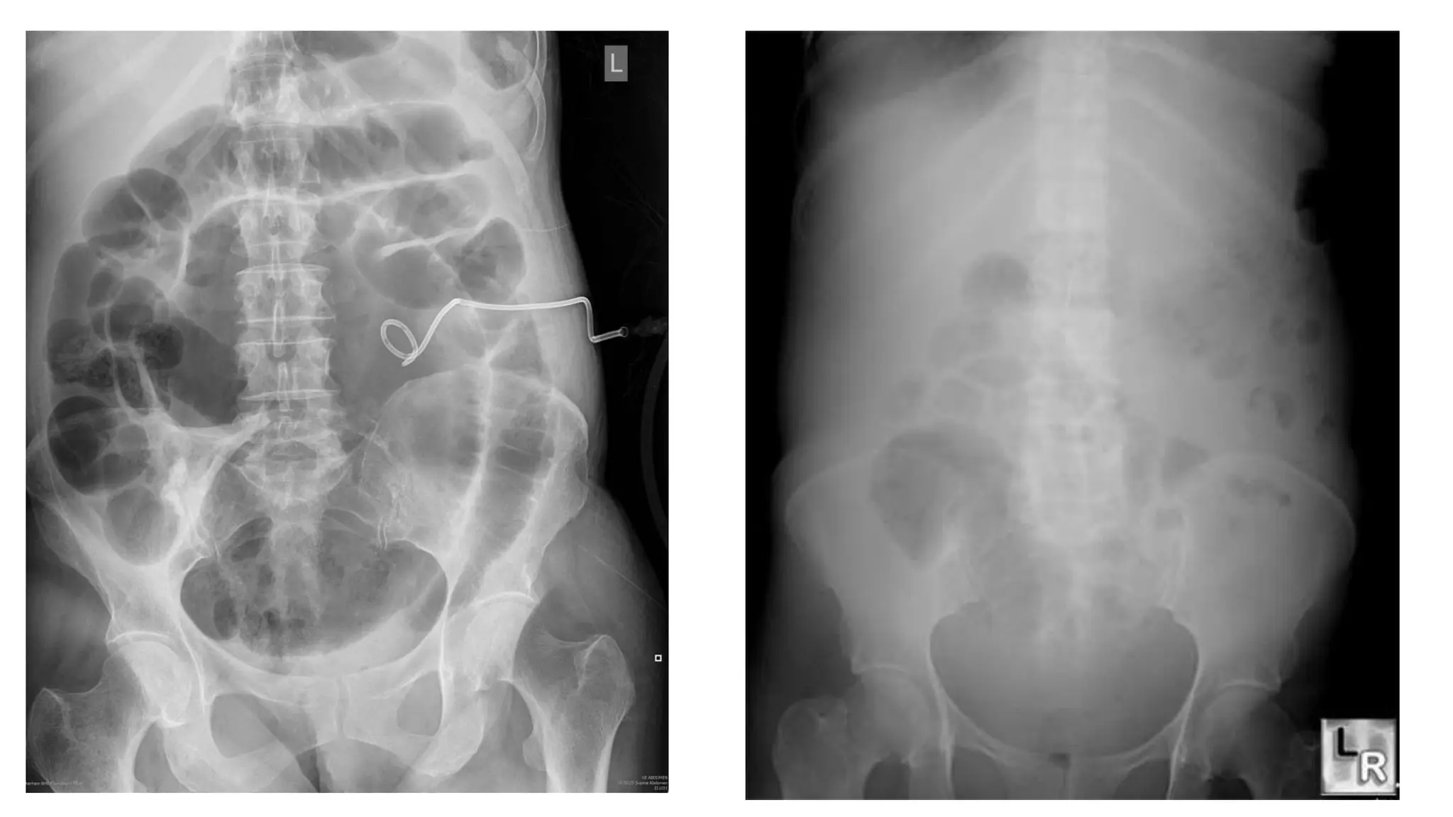 RADIOGRAFI_ABDOMEN_radiologi_abdomen_.pptx