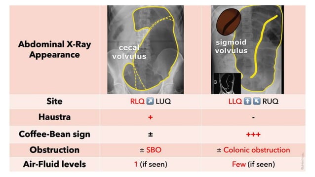 RADIOGRAFI_ABDOMEN_radiologi_abdomen_.pptx
