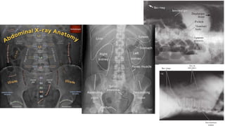 RADIOGRAFI_ABDOMEN_radiologi_abdomen_.pptx