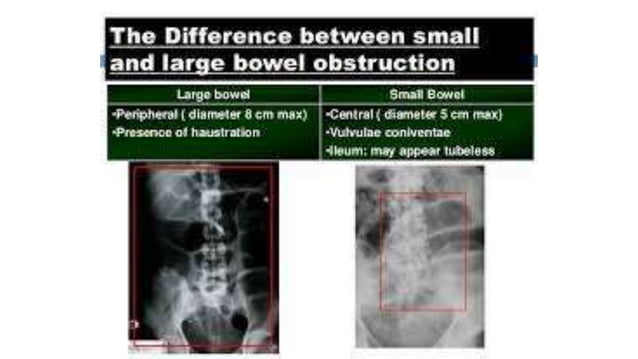 RADIOGRAFI_ABDOMEN_radiologi_abdomen_.pptx | Free Download