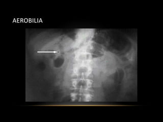 Radiografia de abdomen.pptx