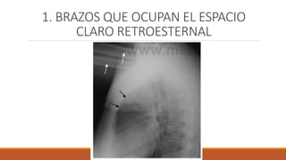 Radiografia de torax | PPTX