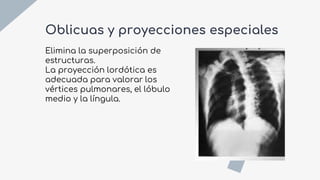 Radiografia de torax | PPTX