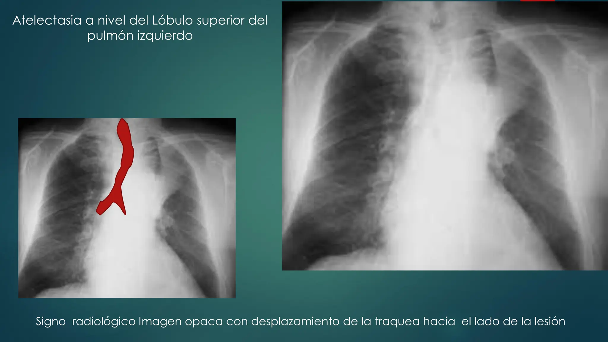 Radiografia De Torax Capítulo Uno Introducción Ppt