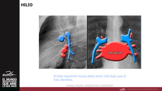 RADIOGRAFIA DE TORAX BASICO PARTE 2 NEUMOLOGIA | PPTX