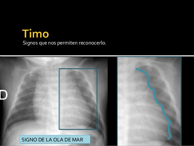Radiografía de tórax. patología común rn y lactante