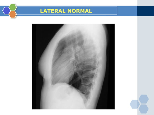 Radiografia de Torax Anormal