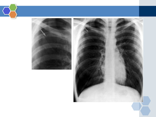 Radiografia de Torax Anormal