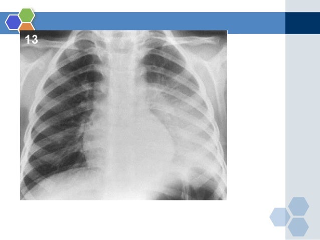 Radiografia de Torax Anormal