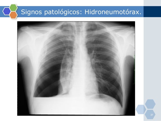 Radiografia de Torax Anormal