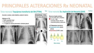 RADIOGRAFIA DE TORAX RADIOGRAFIA DE TORA | PPTX