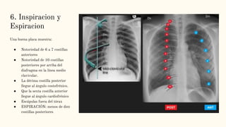 Semiología de Radiografia de torax .pptx