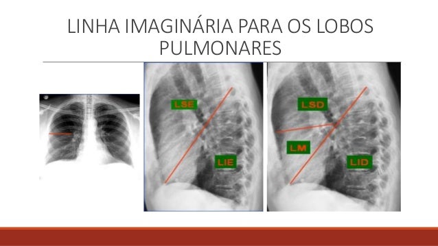 Radiografia de tórax