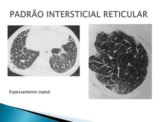 Radiografia de tórax aula2-padrãoacinar-intersticial | PPT