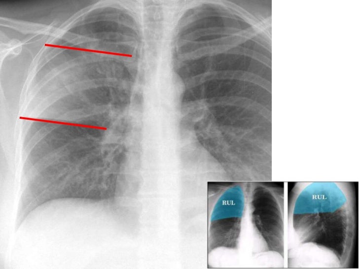 Radiografia de tórax aula2-padrãoacinar-intersticial