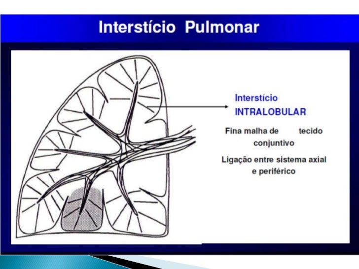 Radiografia de tórax aula2-padrãoacinar-intersticial