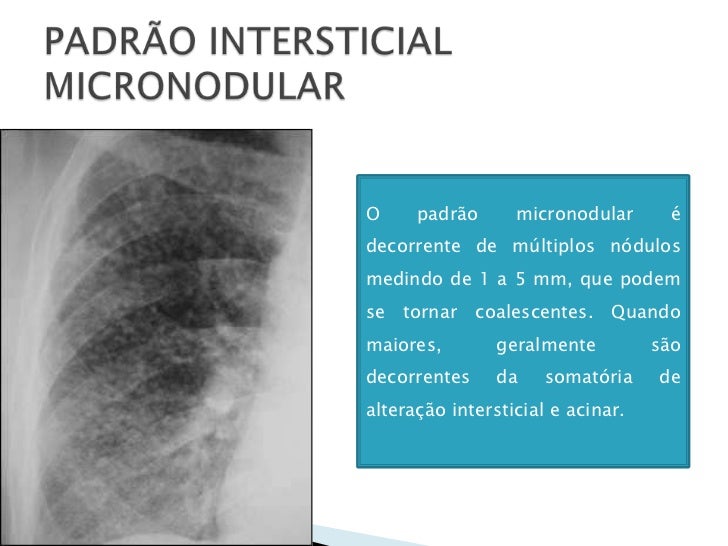 Radiografia de tórax aula2-padrãoacinar-intersticial