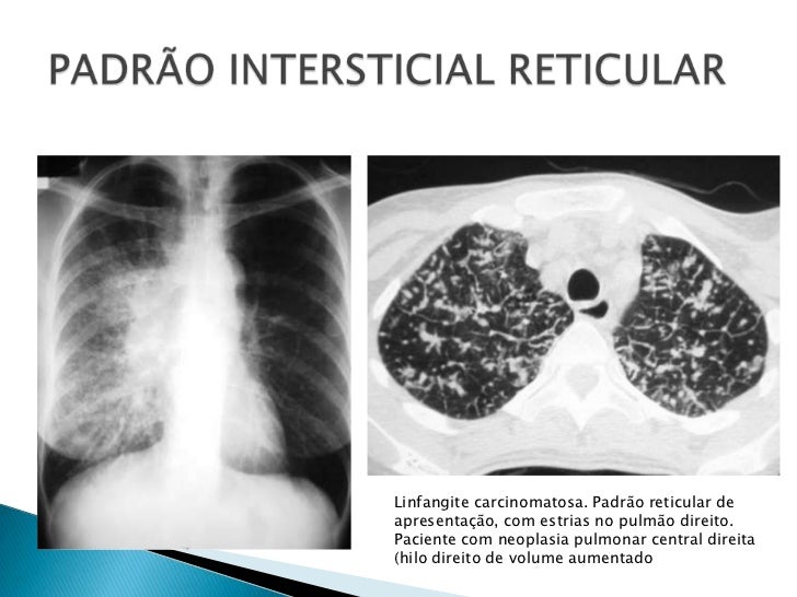 Tac Torax Patron Nodular