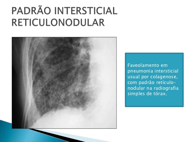 Radiografia de tórax aula2-padrãoacinar-intersticial