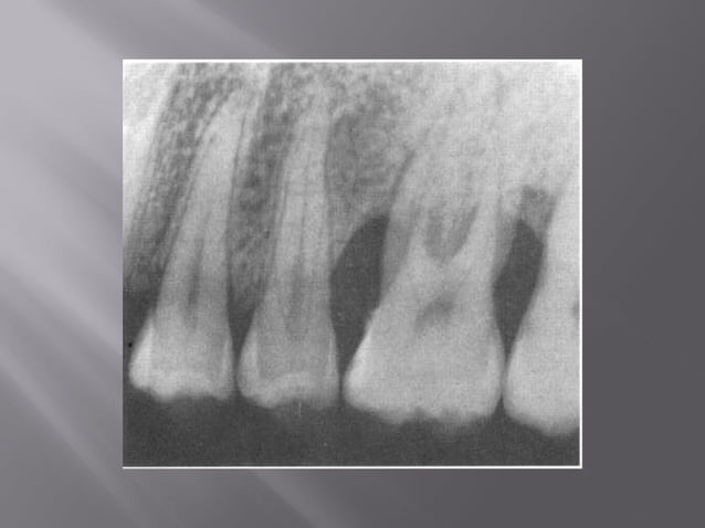 Radiografia En La Enfermedad Periodontal Edison Gonzalez 982436 Tpi 2009 2