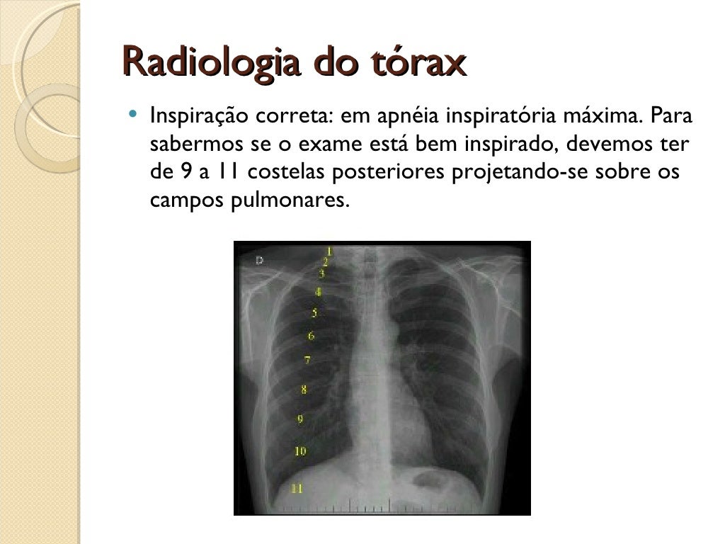 Radiografia normal do tórax