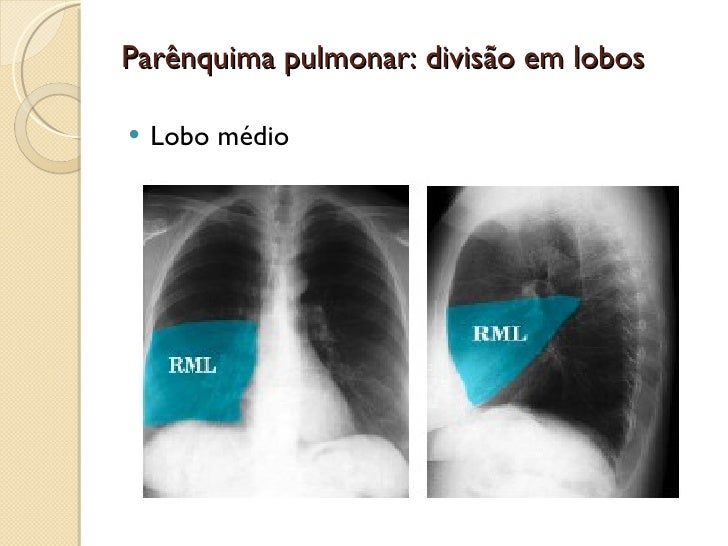 Radiografia normal do tórax