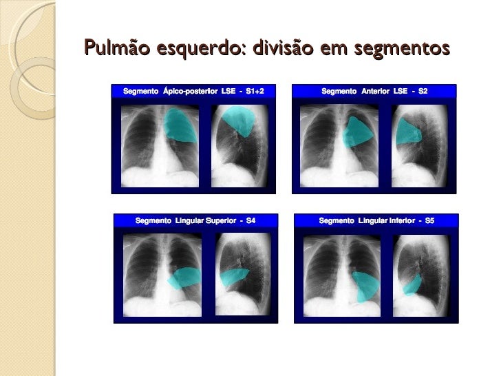 Radiografia normal do tórax