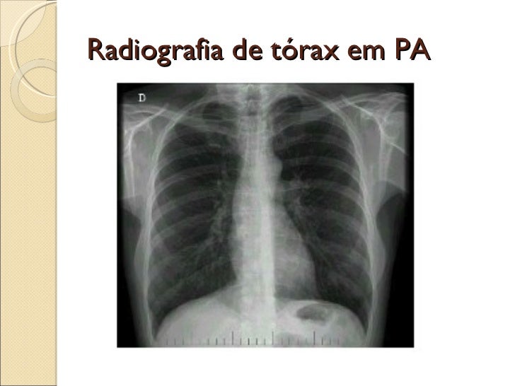 Radiografia normal do tórax