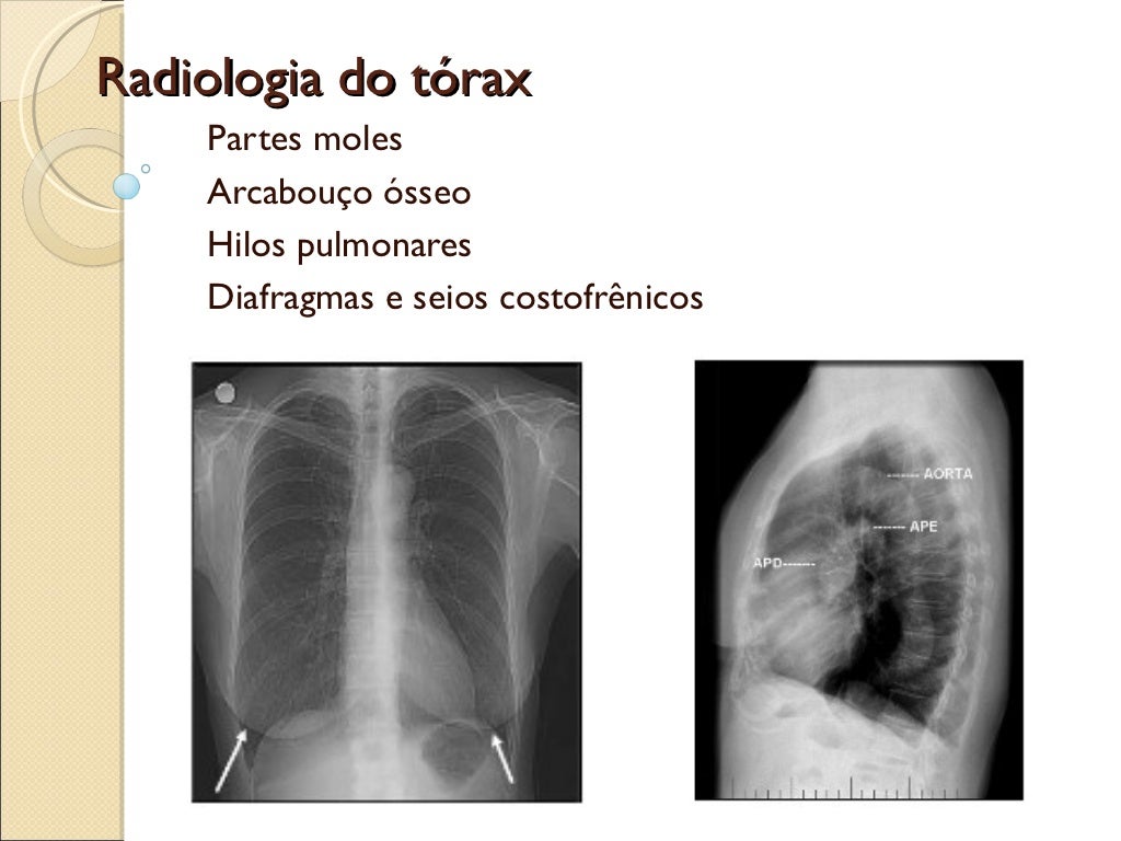 Radiografia normal do tórax
