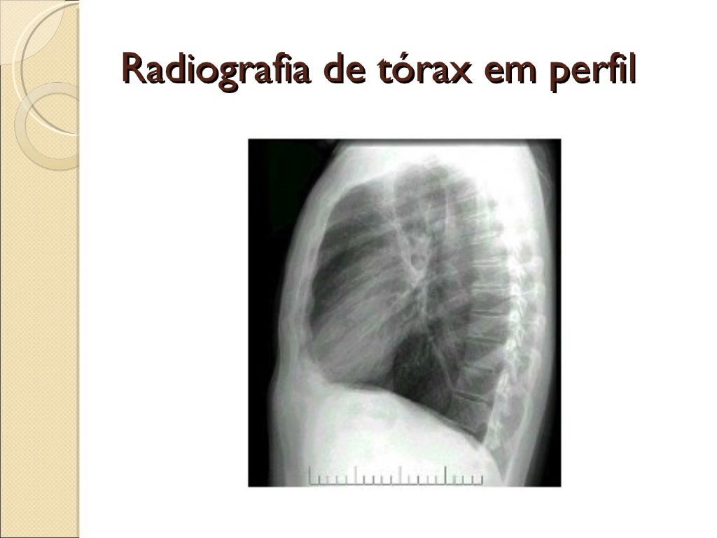 Radiografia normal do tórax