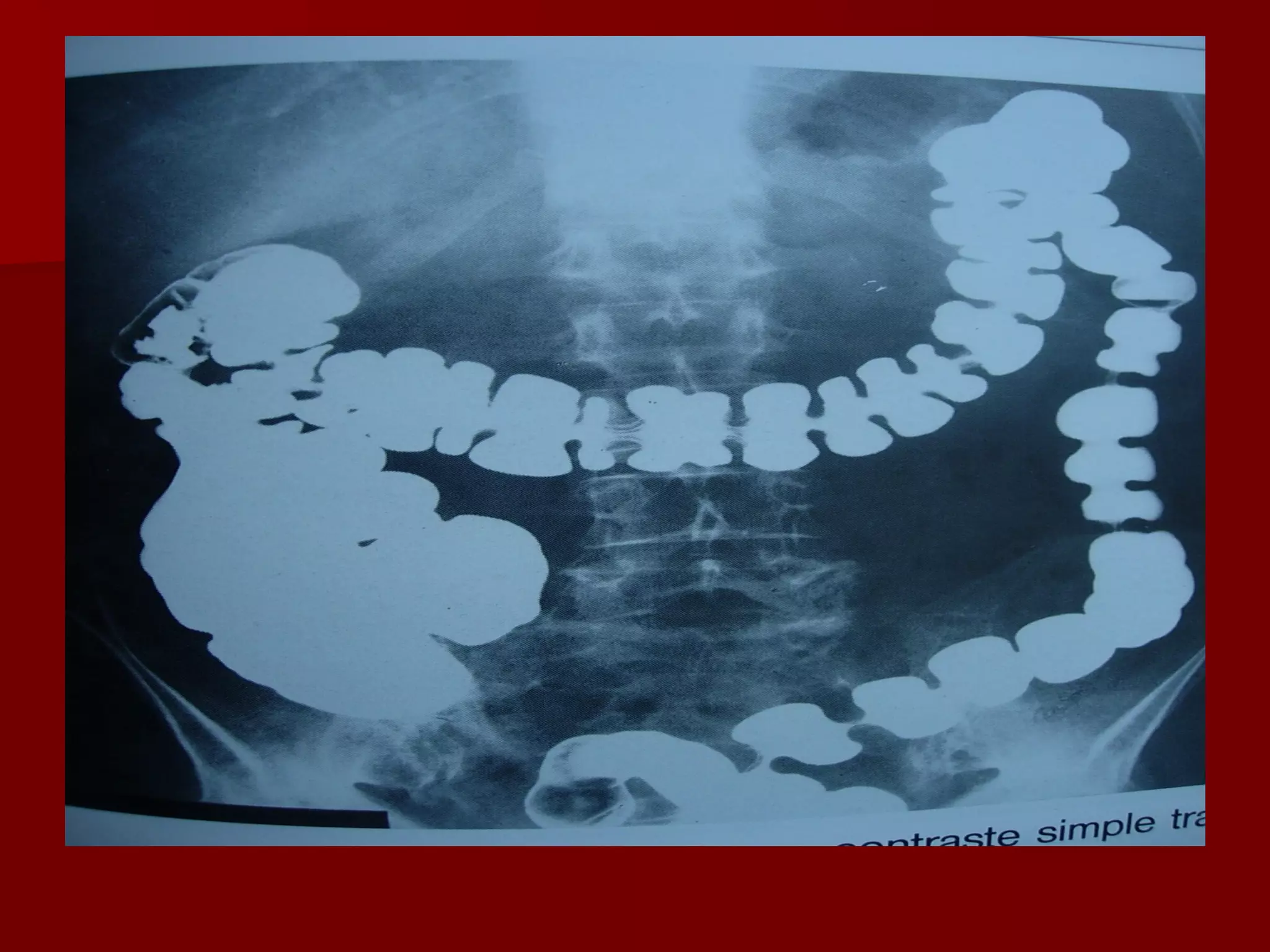 Radiografias De Colon | PPT