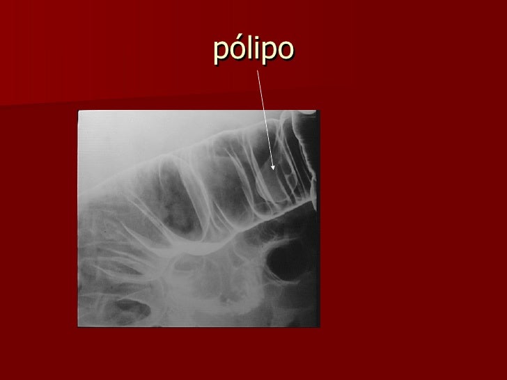 Radiografias De Colon