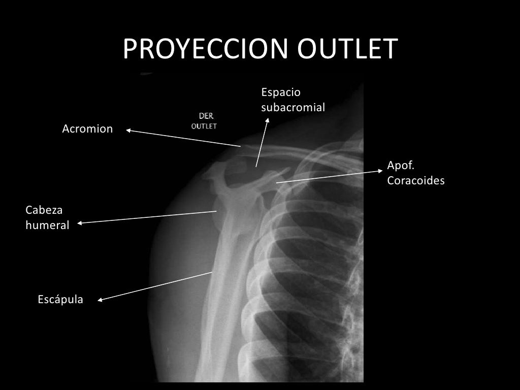 Hombro Vista Lateral