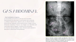RADIOGRAFIA SIMPLE DE ABDOMEN Y SU INTERPRETACION | PDF