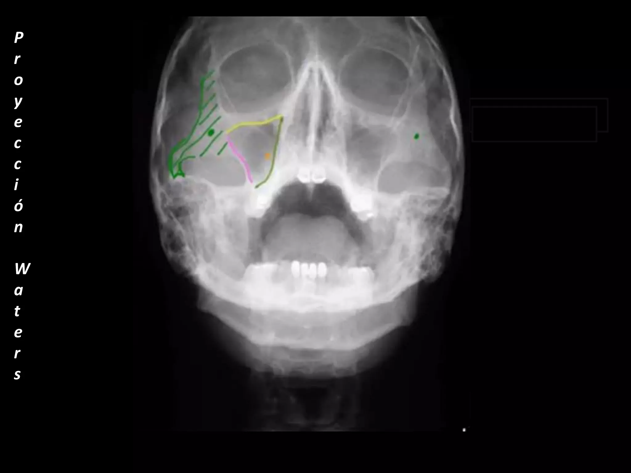 Radiografia spn y orbita | PPTX | Ear, Nose and Throat Conditions ...